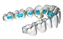 Aparat Dentar Invizibil